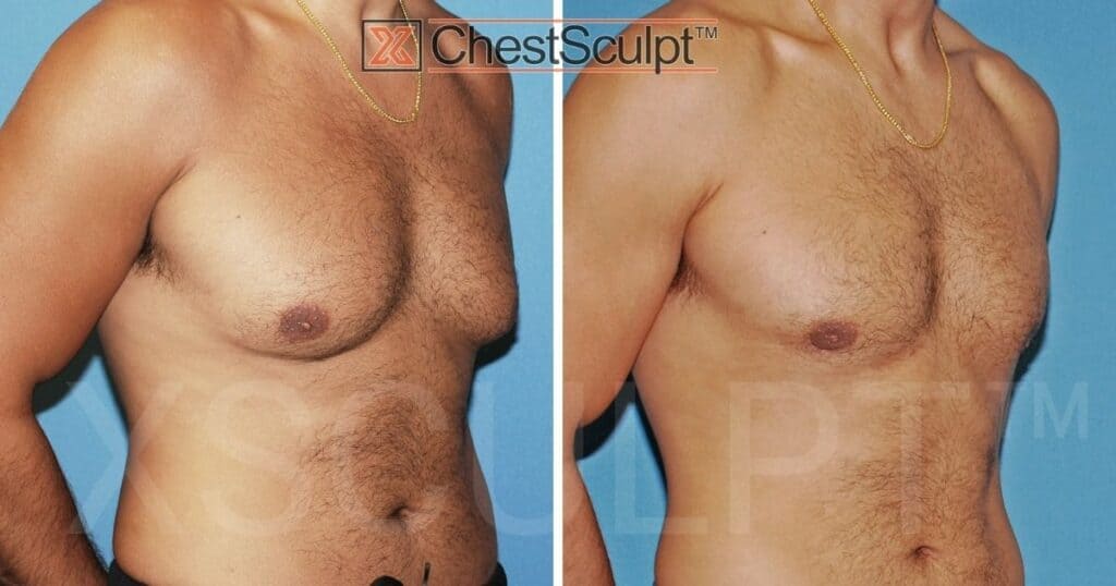 Pseudogynecomastia | GynecomastiaMD