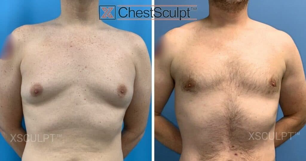 Pseudogynecomastia | GynecomastiaMD