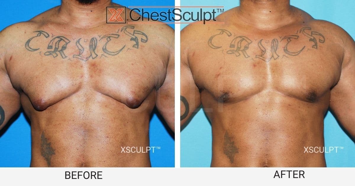 GynecomastiaMD | Gynecomastia Surgery Leaders USA