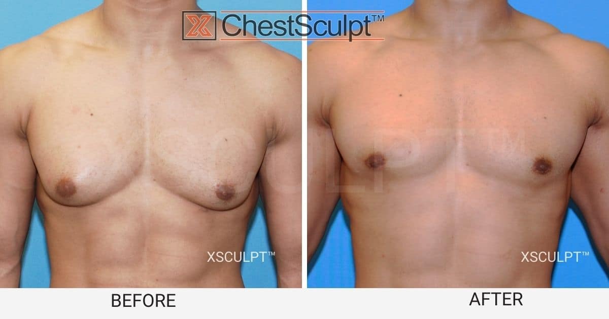 GynecomastiaMD | Gynecomastia Surgery Leaders USA